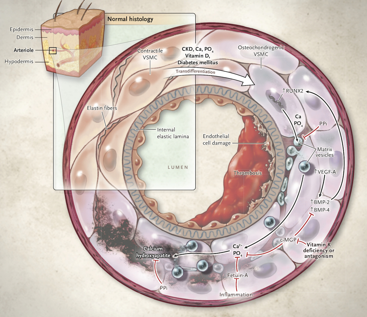 Medical Terms & Сlinical Сases : Calciphylaxis