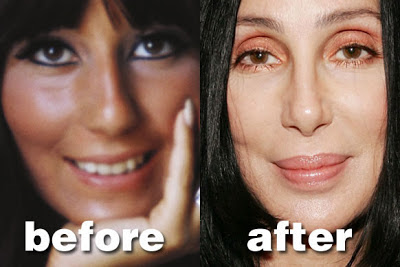 Cher plastic surgery Before and After Botox and Nose Jobs (Star plastic ...