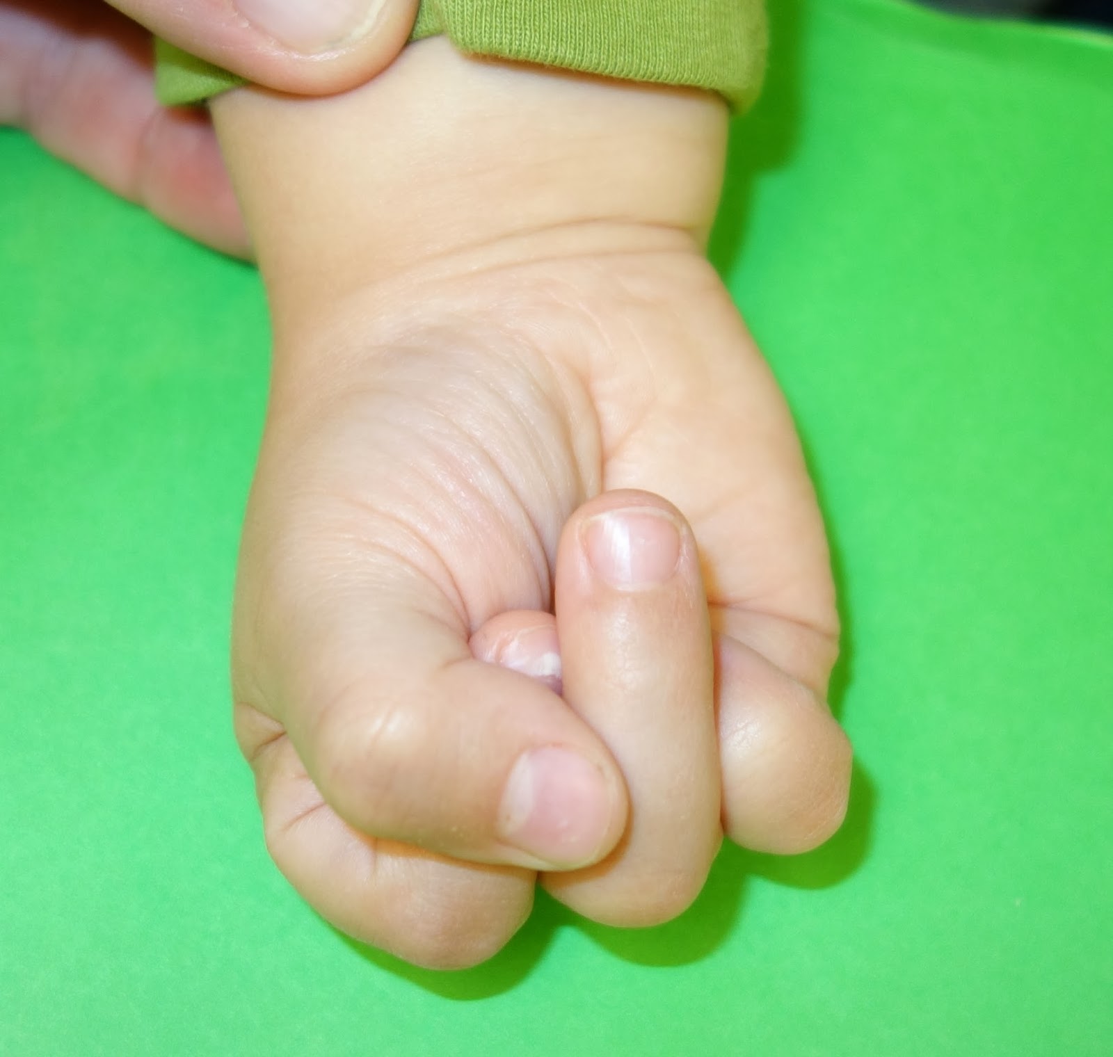 Challenges with Cleft Hand Reconstruction | Congenital Hand and Arm ...