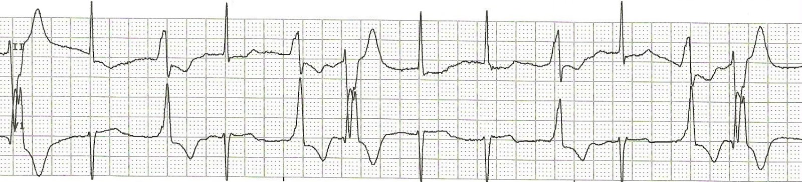ECG Rhythm Strip Quiz 63