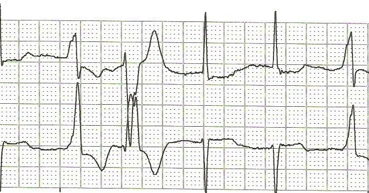 ECG Rhythm Strip Quiz 63