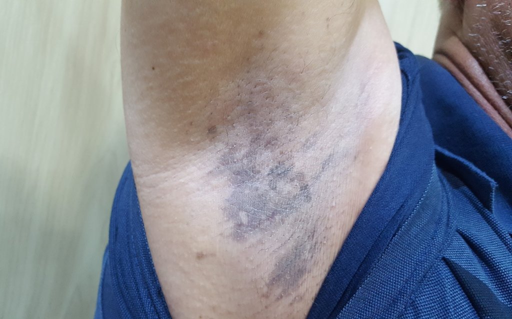 Dermatology Made Easy: Flexural lichen planus