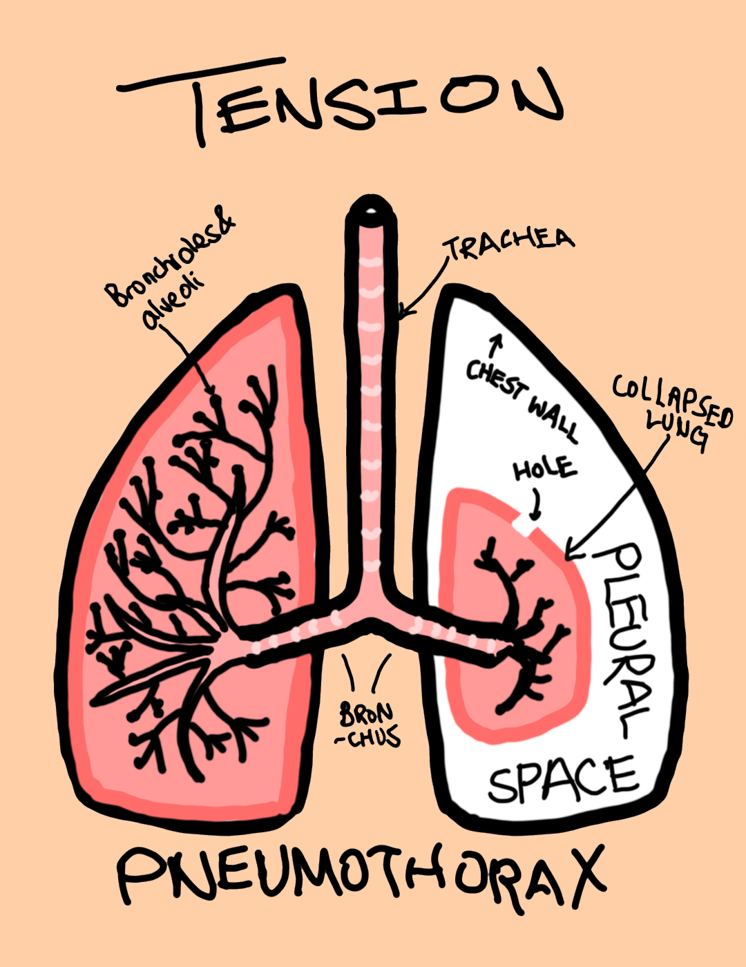 Medical Fun facts: Pneumothorax and Hemothorax