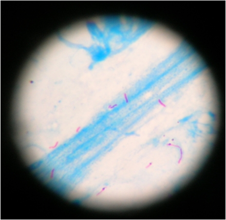 Pemeriksaan Dahak (Sputum BTA) | Analis Kesehatan