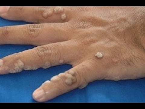 30 Jenis Penyakit Kulit Dan Penyebabnya - Info Kesehatan