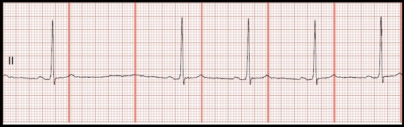 Practice EKG Rhythm Strips 157