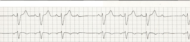 EKG Rhythm Strips 31: Heart Block Challenge part II