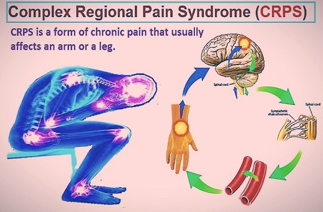 Complex Regional Pain Syndrome (CRPS) - Symptoms, Causes and Treatment