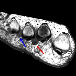 Intermetatarsal Space