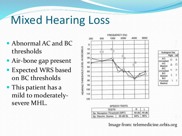 HEARING LOSS , AUDIOGRAM INTERPRETATION