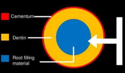 Monoblock in Endodontics [Detailed Explaination with Studies]