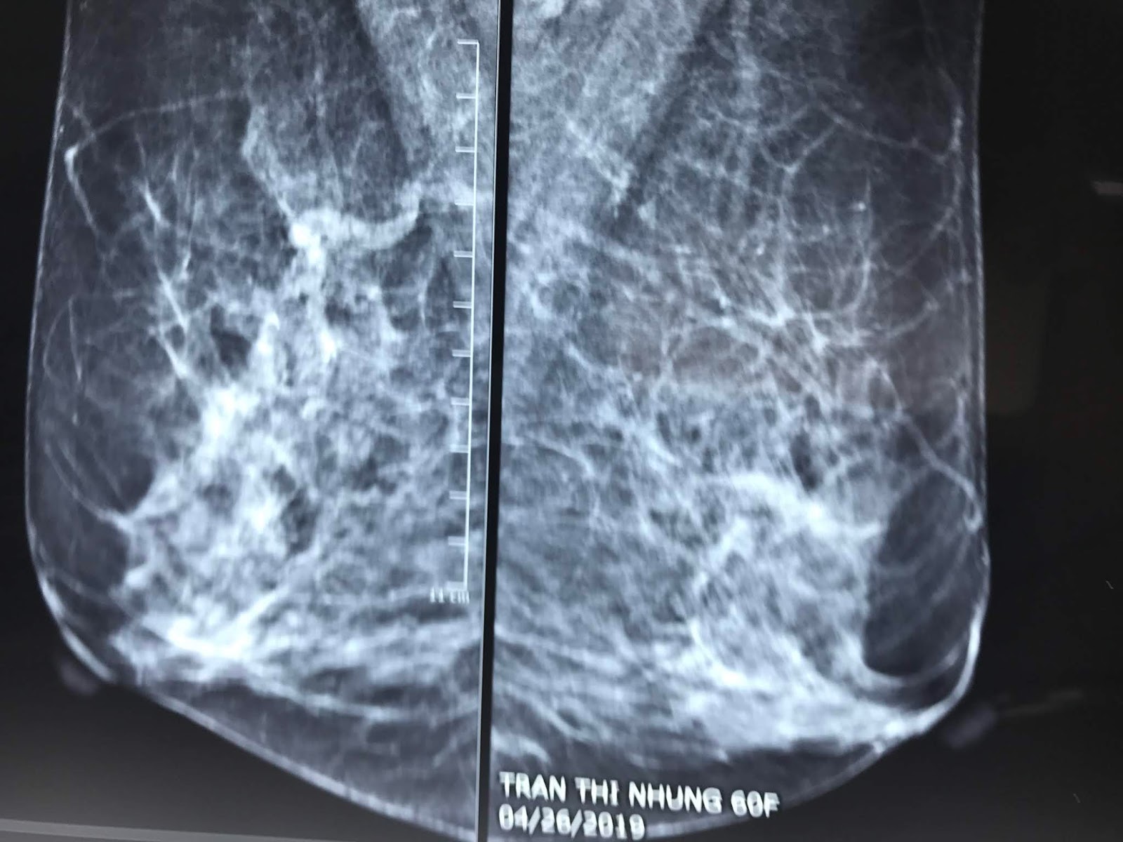 VIETNAMESE MEDIC ULTRASOUND: CASE 547: MONDOR'S DISEASE, Dr PHAN THANH ...