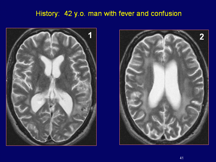 MRI& CT Signs: Encephalitis