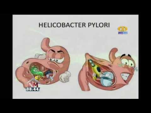 INFECCIÓN DE H. PYLORI