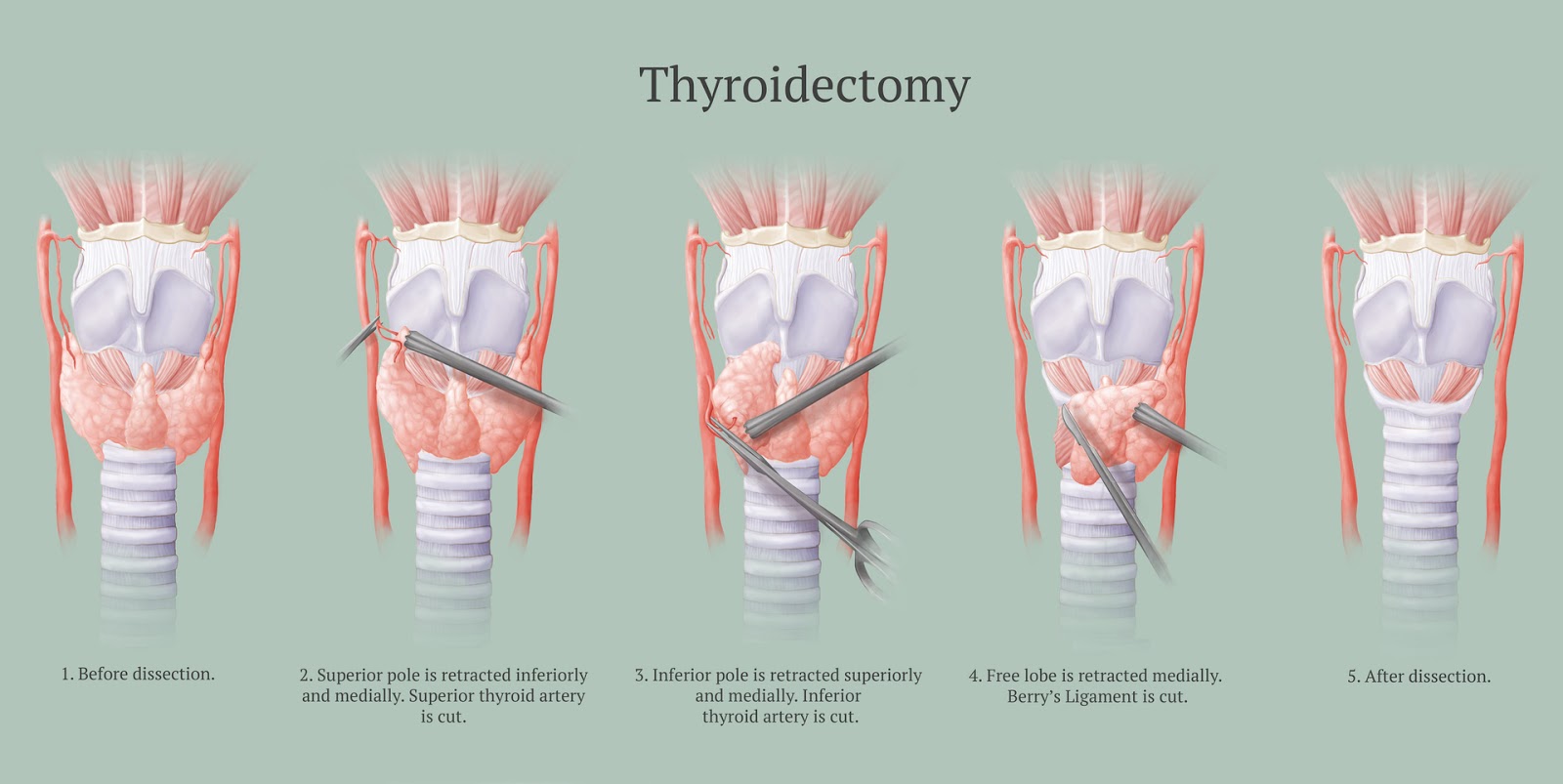 Thyroidectomy Anatomy thyroidectomy-anatomy