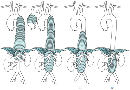 Acute Type A Aortic Dissection Case File