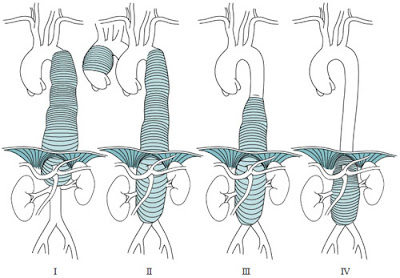 Acute Type A Aortic Dissection Case File