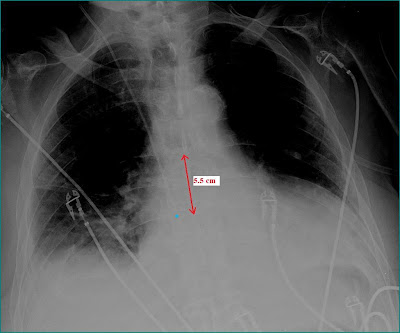 Is this right IJ central line correctly placed as noted on chest x-ray ...