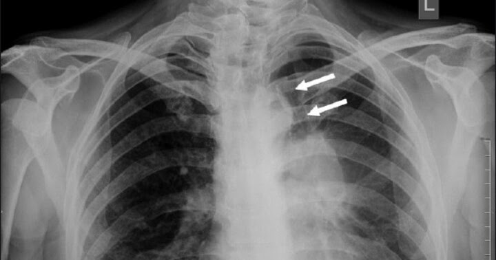 Chest Medicine Made Easy-Dr Deepu: The Luftsichel Sign