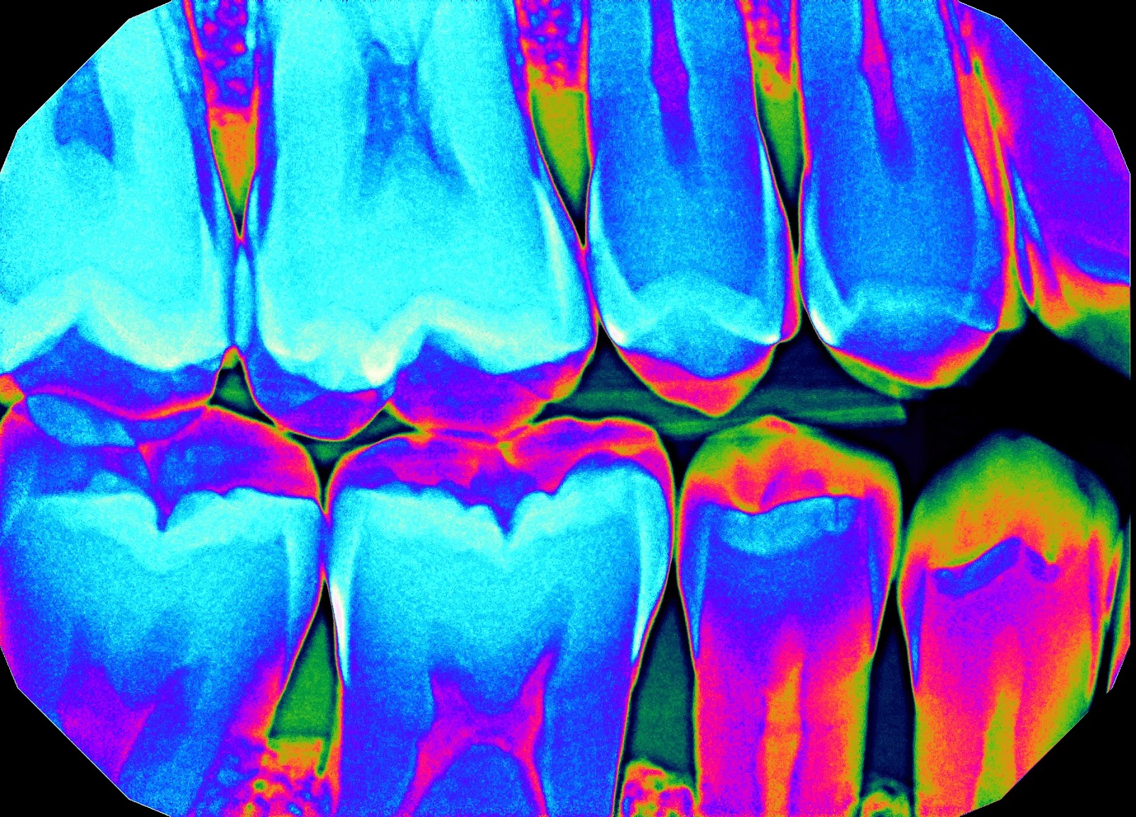 Dental X Ray Colors at Barbara Eley blog