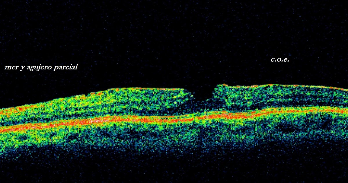 DEGENERACION MACULAR : MEMBRANAS en retina