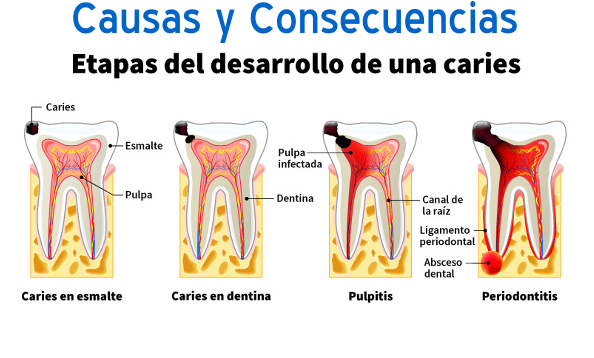 Caries Síntomas y Consecuencias