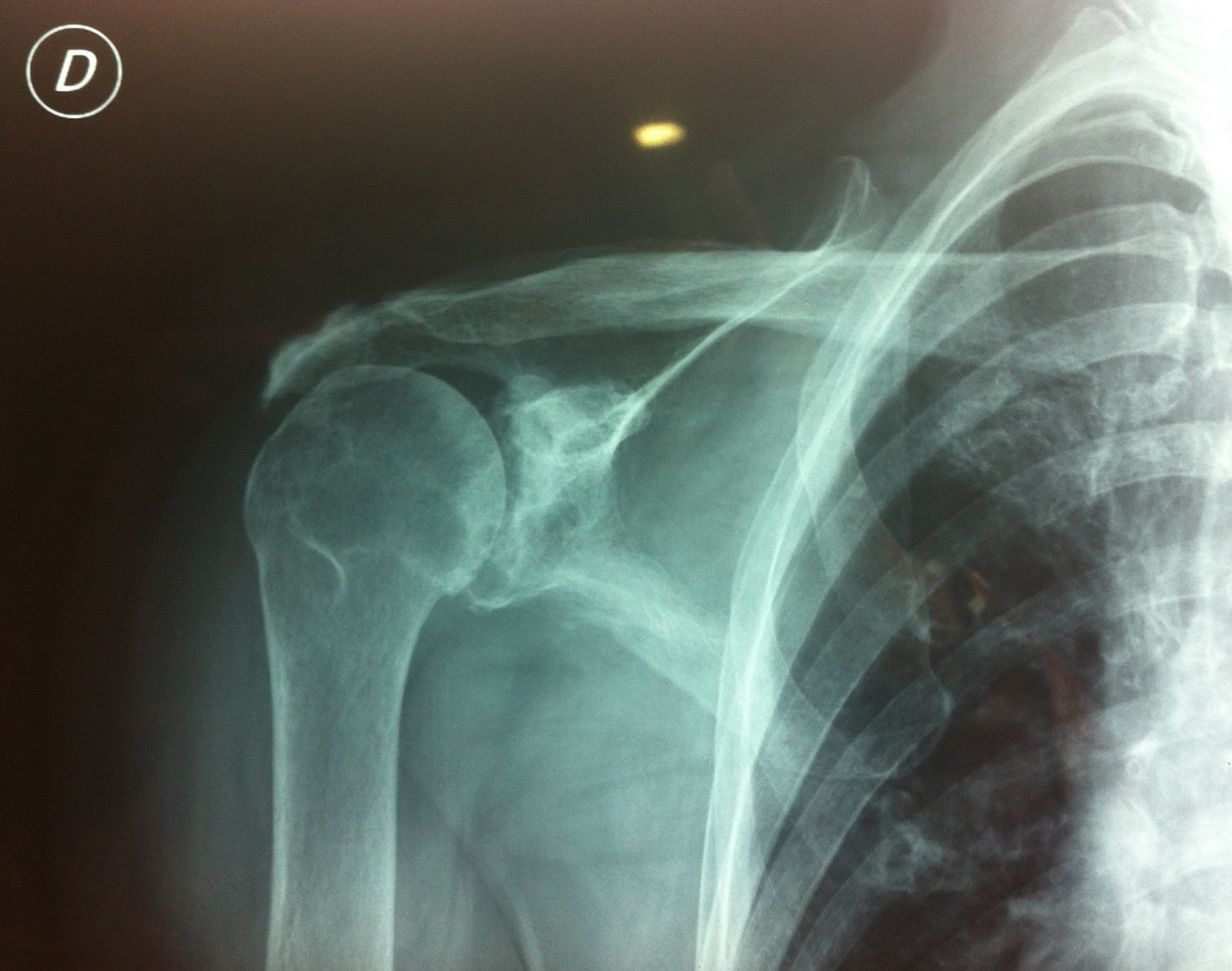 Reumails. Reumatología al día: Imágenes clínicas: Codos y hombros ...