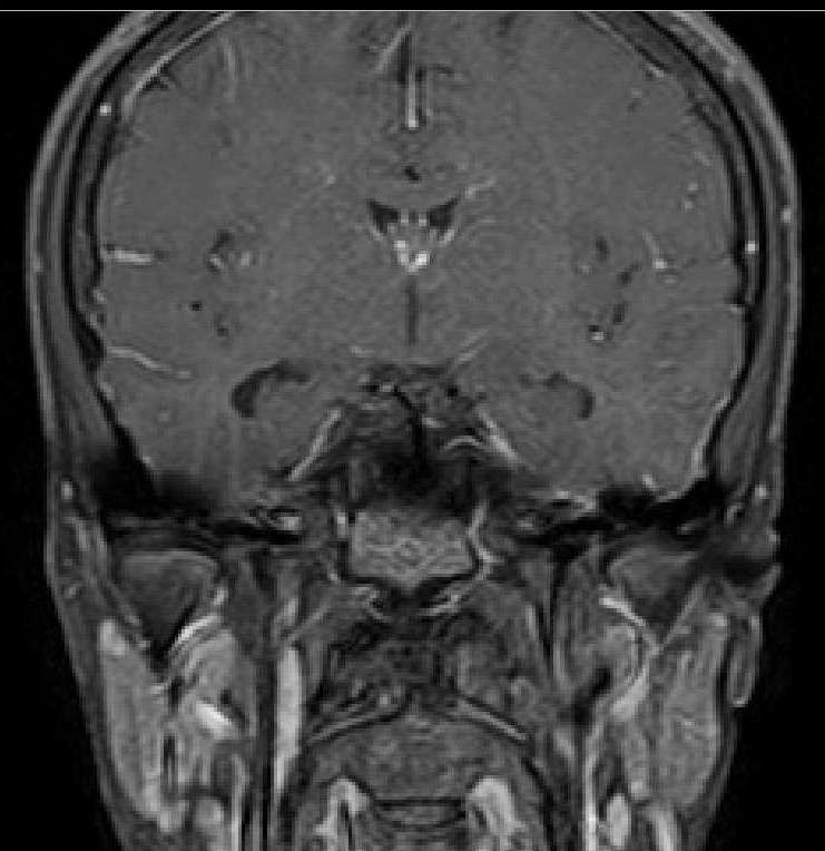 Colloid cyst of third ventricle - missed on MRI - Sumer's Radiology Blog