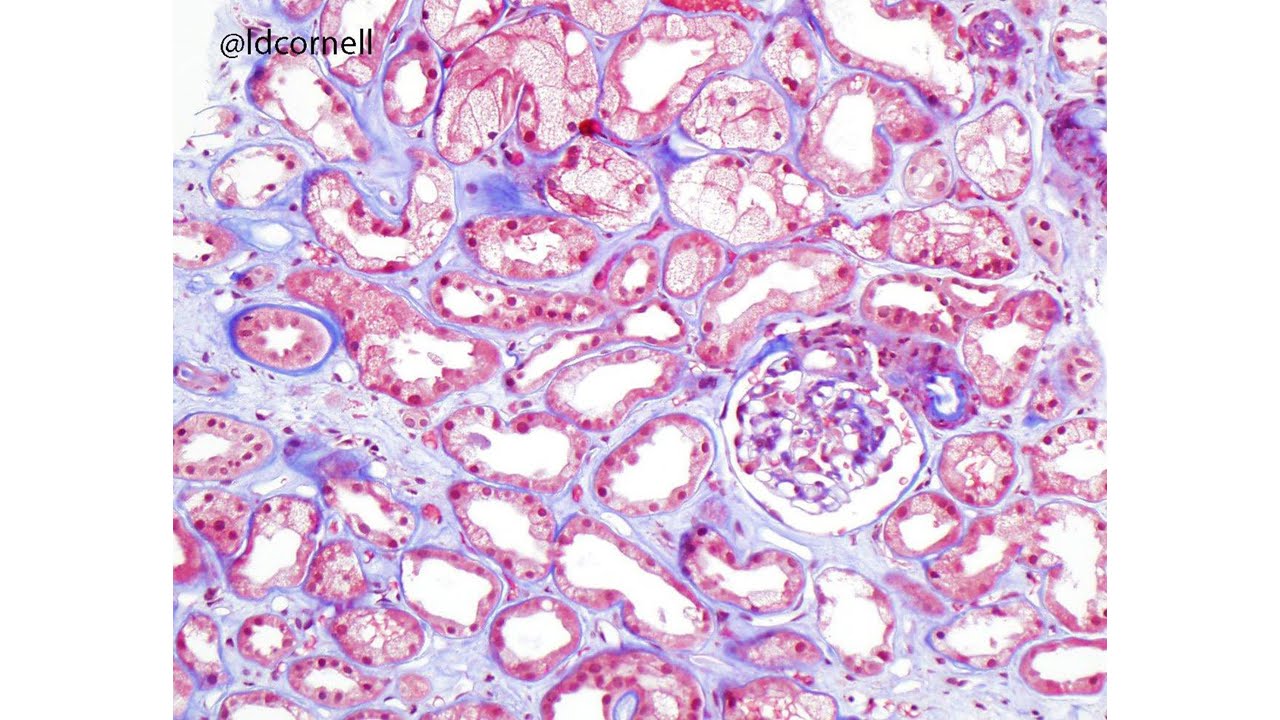 Nephron Power: Topic Discussion: Osmotic Nephrosis