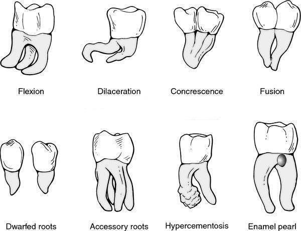 Dentistry and Medicine: Developmental anomalies of tooth - Diagram
