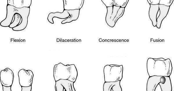 dentalaka: Developmental anomalies of tooth - Diagram