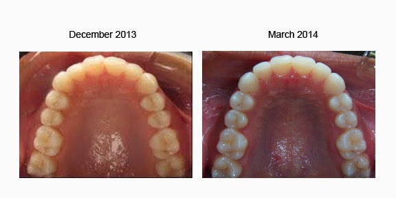 Toronto Invisalign - Brand New Smile :): Progress Photos With My ...
