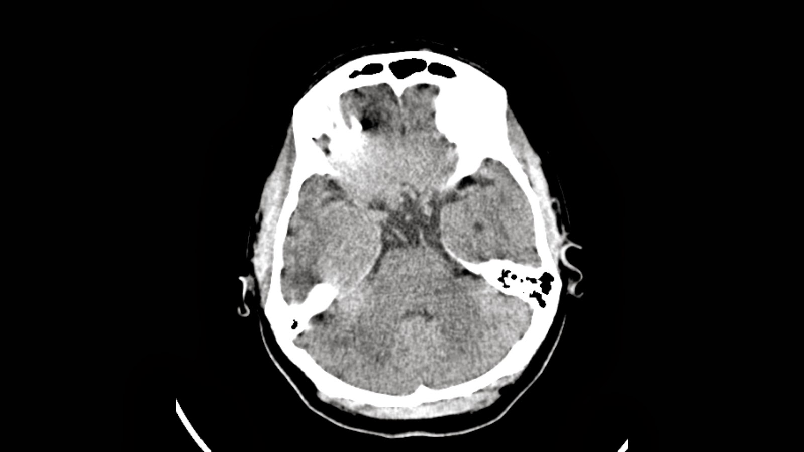 Ultimate Radiology : Fetal PCA