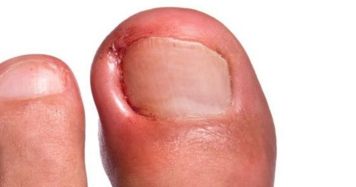 Causes of ingrown toenail and Methods of Treatment | 코리언리더