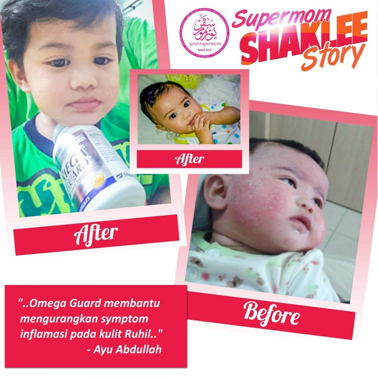 Ubat Antibiotik Untuk Chicken Pox - Jurupulih l