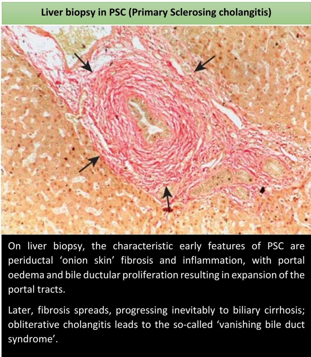What is Primary Sclerosing cholangitis (PSC )?