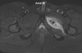 mricases: Perineal injury - Foreign body in the obturator externus ...