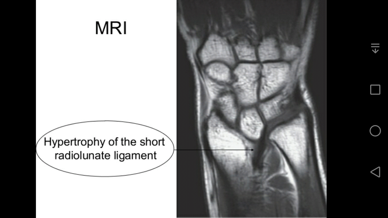 Spot diagnosis? Identify the deformity at wrist ? Madelung deformity