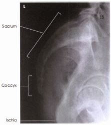 Sacrum Anatomy Xray