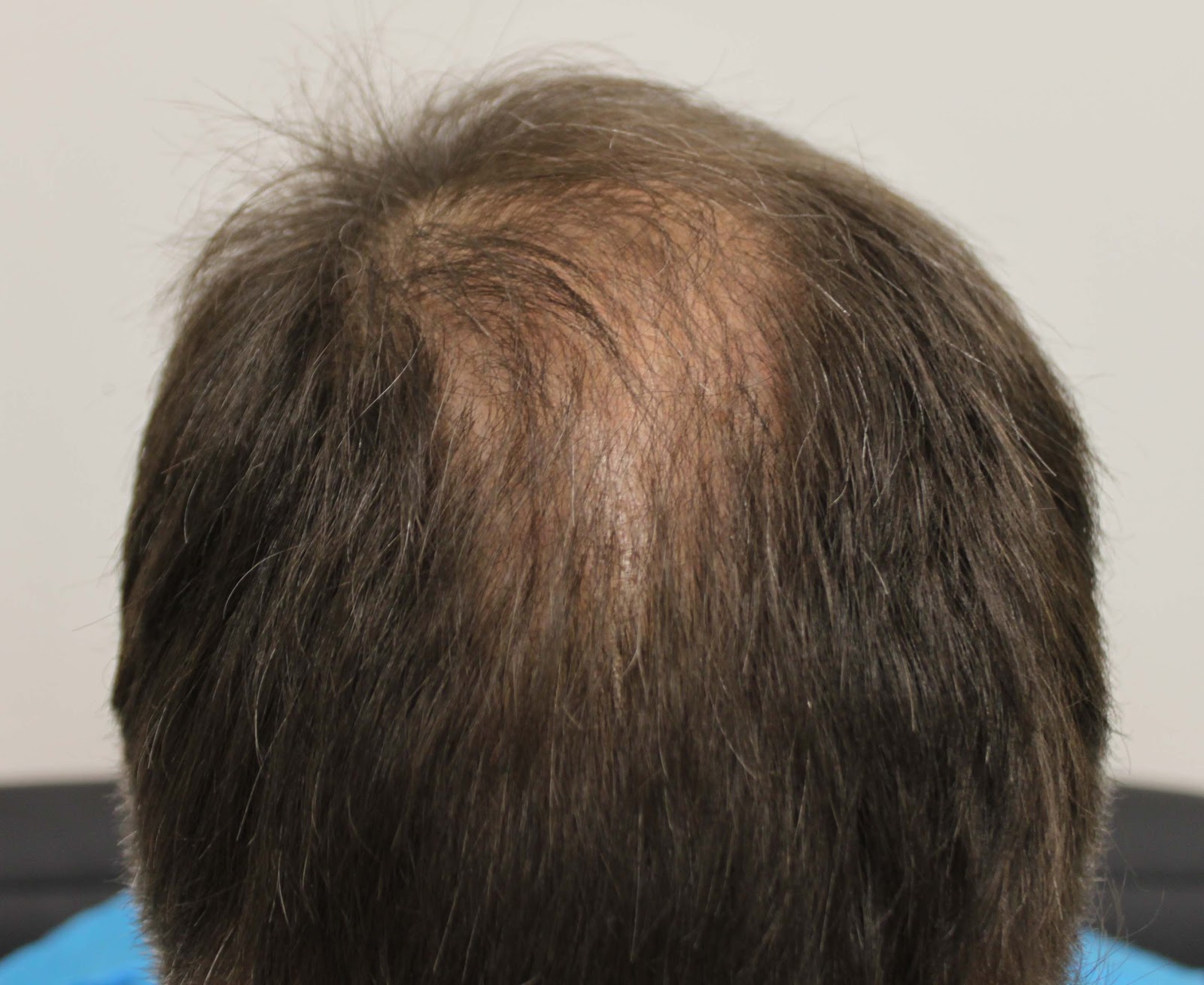 Selston Cosmetic Clinic: Restoration Of The Crown...Before And After