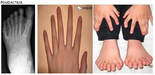 Quimica - Biologia: POLIDACTILIA - SINDACTILIA