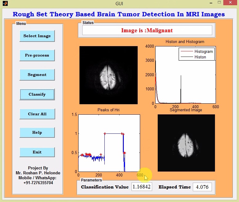 Rough Set Theory Based Brain Tumor Detection On Dicom Images Matlab