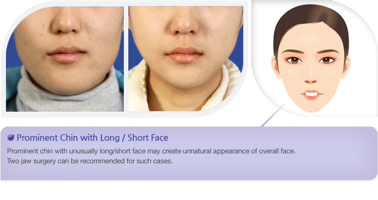 BK Plastic Surgery: [BK Plastic Surgery] Protruding Chin Correction