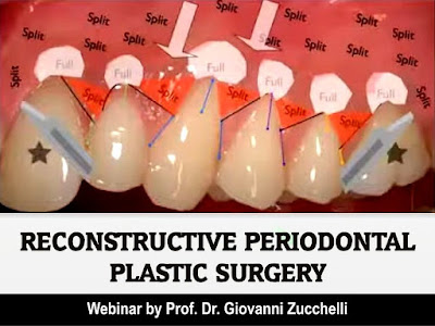 WEBINAR: Reconstructive Periodontal Plastic Surgery in the esthetic ...