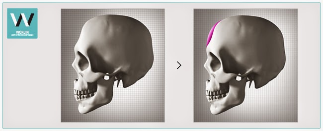 Operasi awet muda & dahi di RS Wonjin