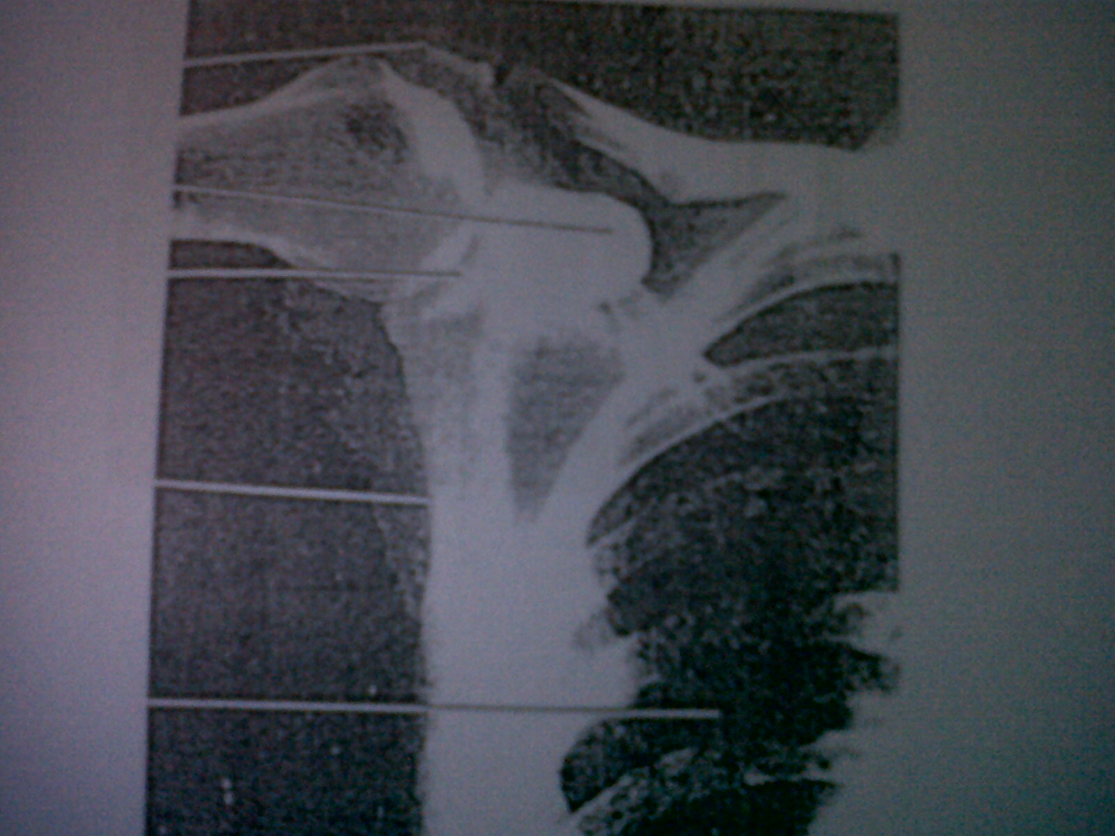 Proyeksi pemeriksaan Scapula | Aditya Radiografer