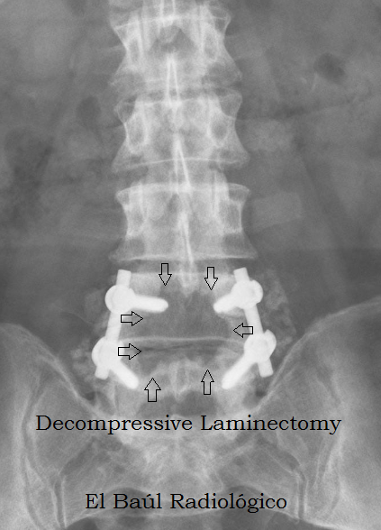 El Baúl Radiológico: SEROMAS POSTQUIRÚRGICOS PARAVERTEBRALES (Lumbar ...