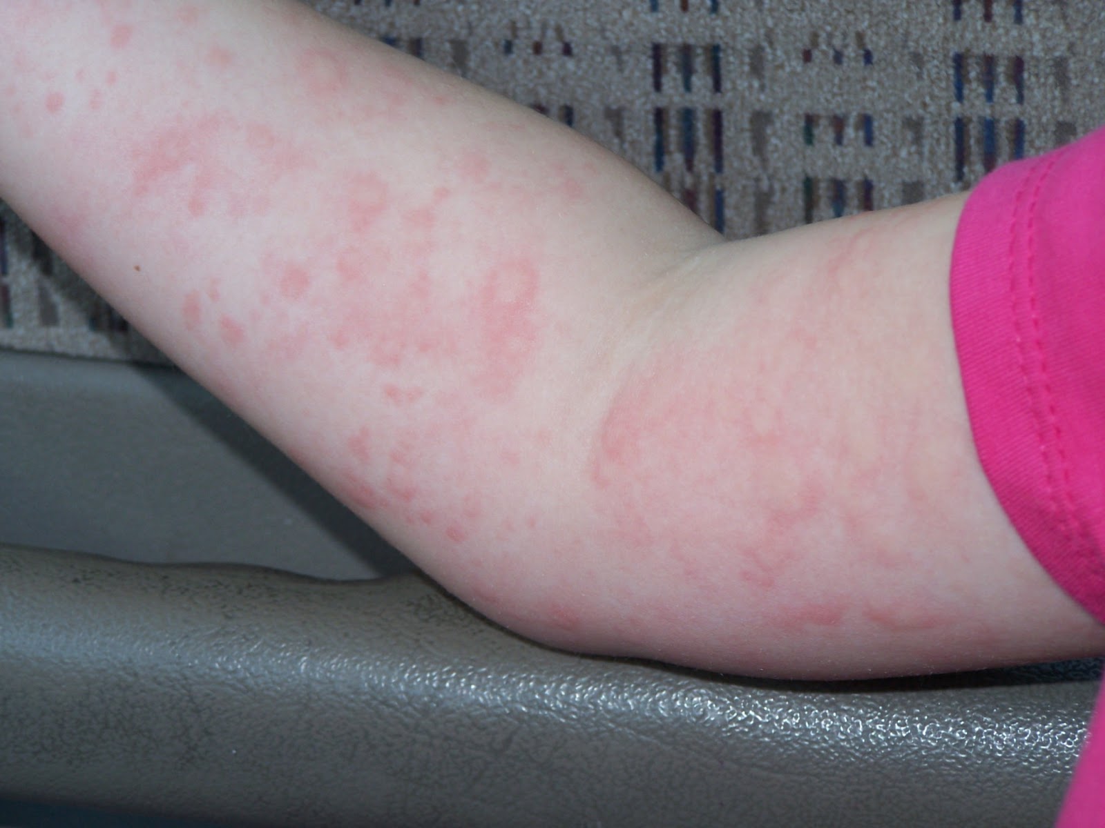 Beyond the Mirror: What Cold Induced Urticaria Looks Like