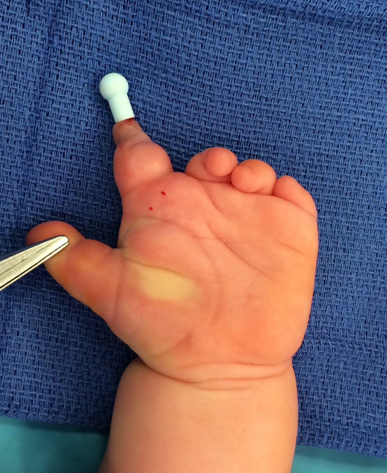 Only a thumb. Amazing outcome! | Congenital Hand and Arm Differences ...
