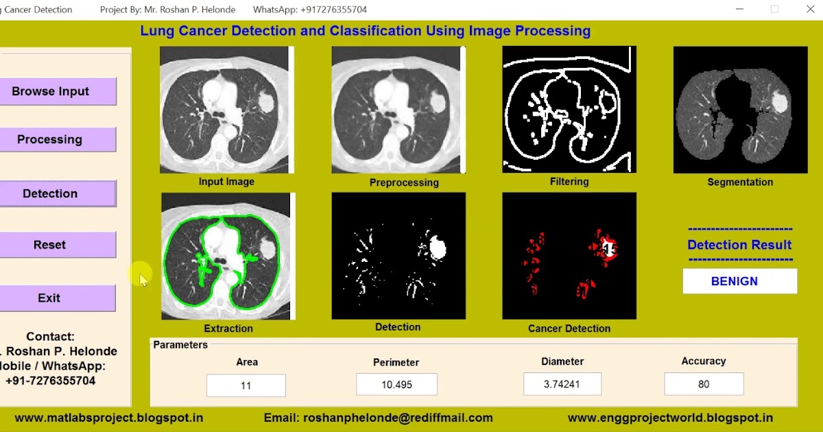 Matlab Code For Lung Cancer Detection Using Image Processing ~ Engineering Projects